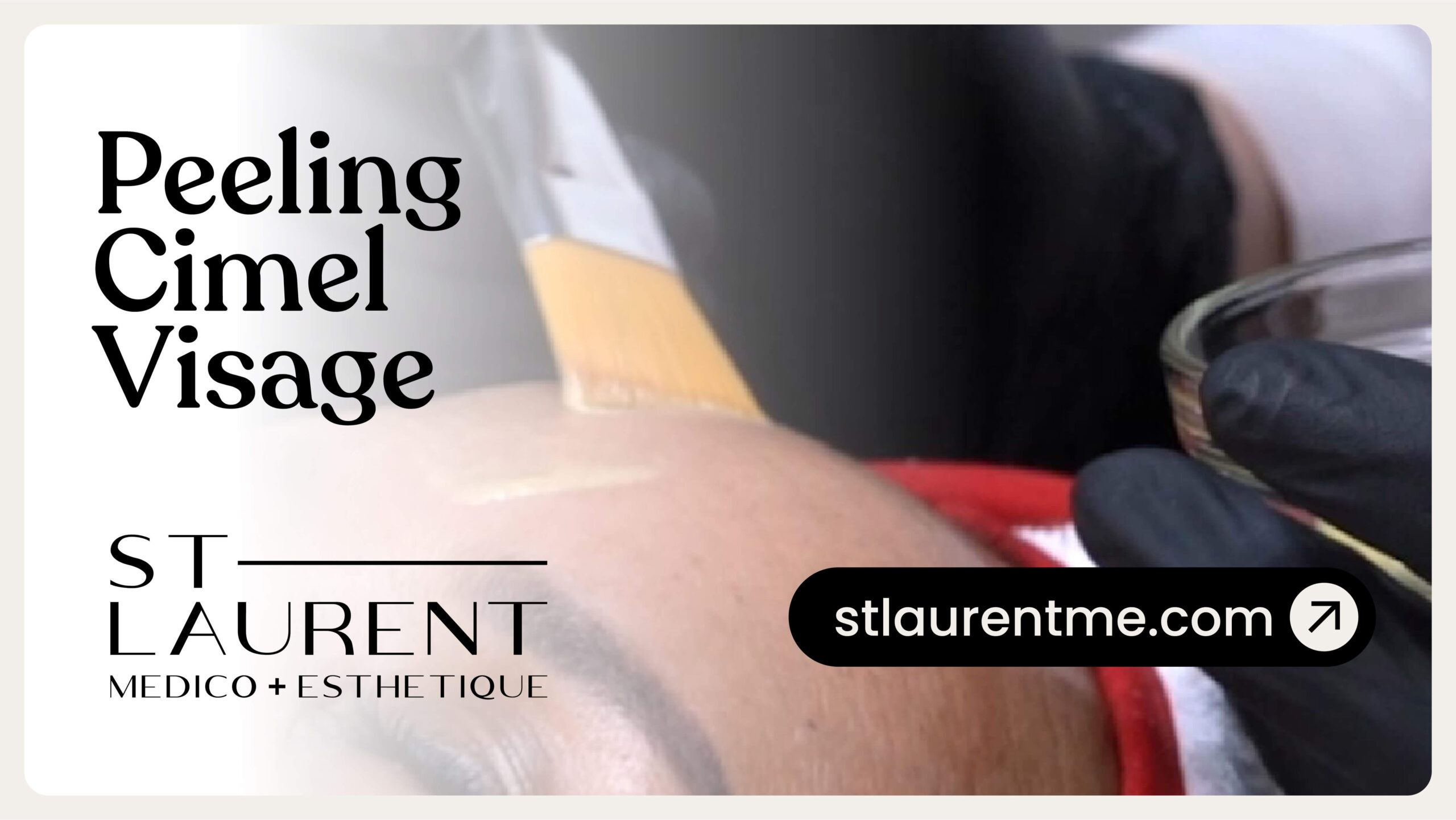 Peeling Cimel | St-Laurent Médico-Esthétique