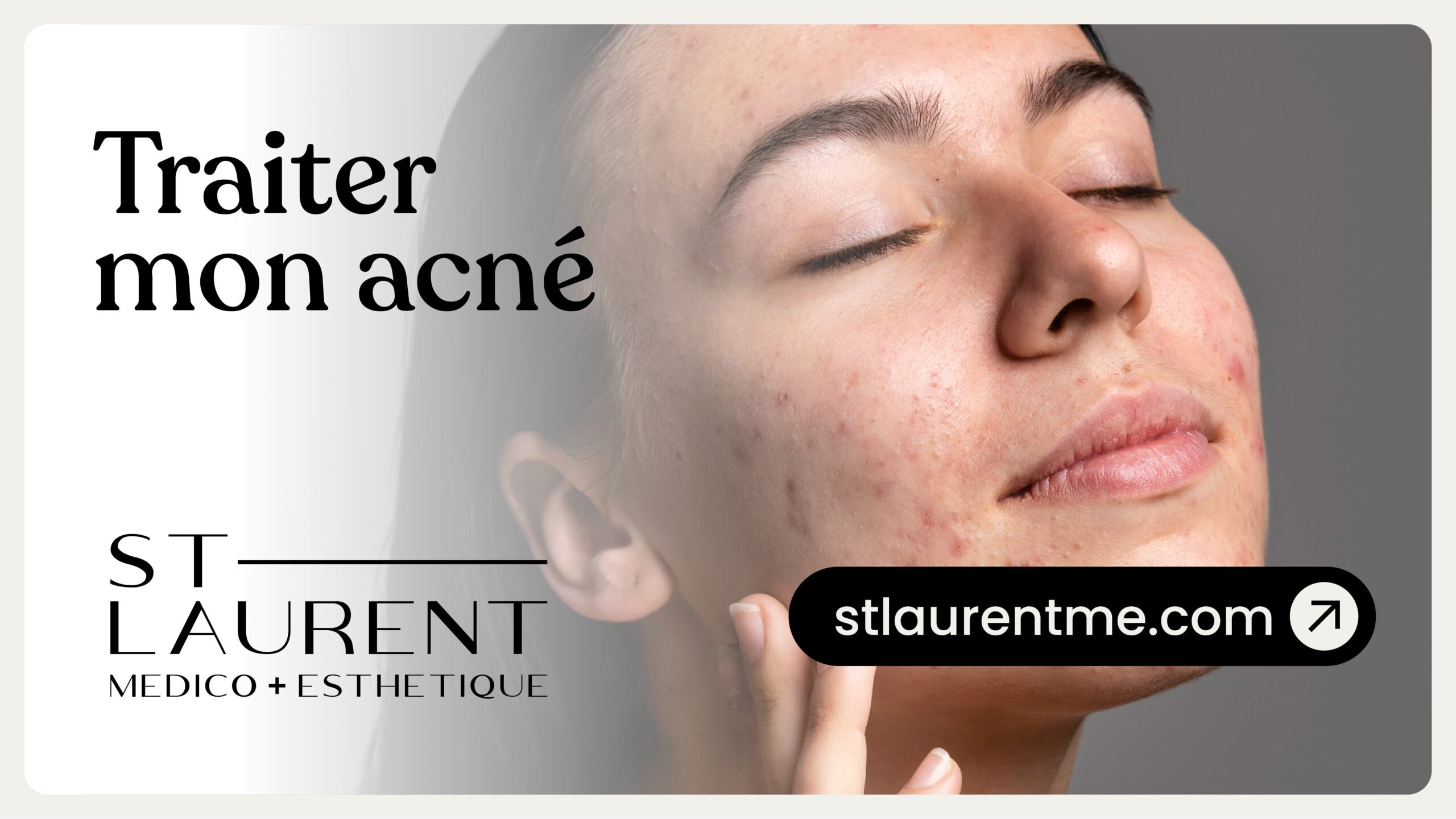 Acné et Cicatrice acné | St-Laurent Médico-Esthétique